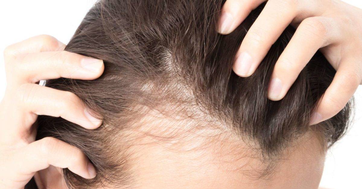 Hair Thinning On One Side of Head - Causes & Solutions – DS Healthcare ...