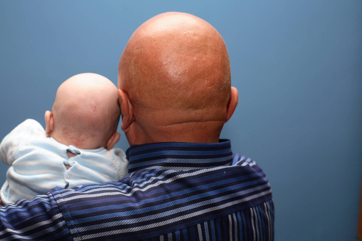 Is There Really A Balding Gene That Makes You Lose Hair? – DS ...