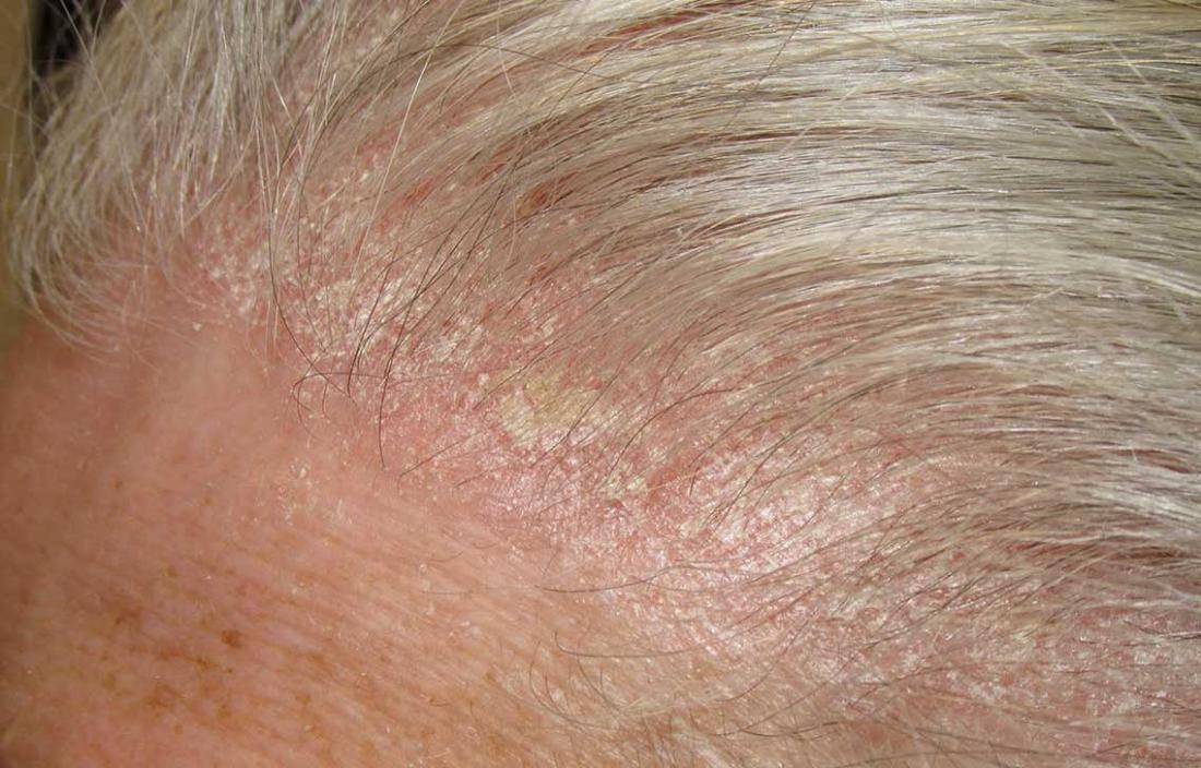 How To Treat A Scabby Scalp – DS Healthcare Group