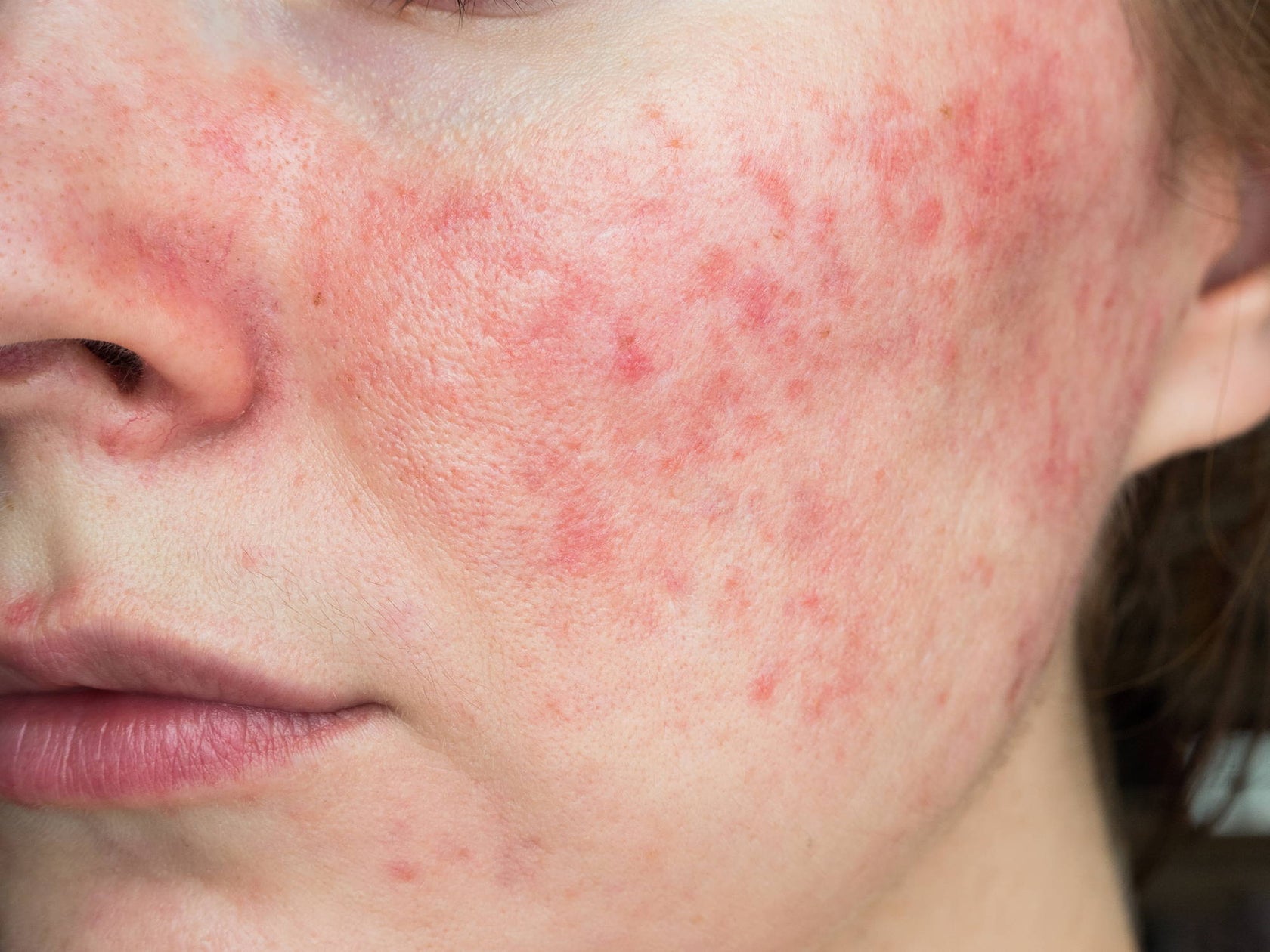 How Common Is Hair Thinning From Accutane DS Healthcare Group how-common-is-hair-thinning-from-accutane-ds-healthcare-group