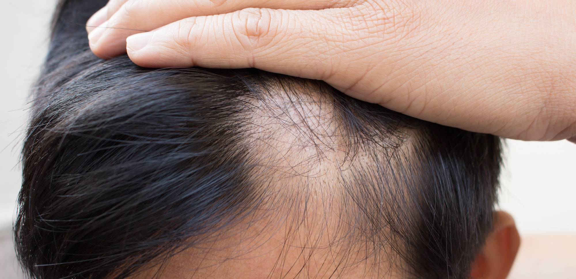 Can Androgenic Alopecia Be Reversed DS Healthcare Group